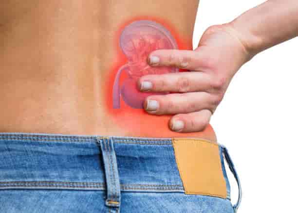 Kidney Stones: Causes, Symptoms, Diagnosis & Treatment