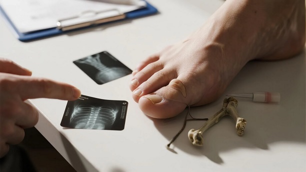 How to Know If Toe is Broken: Symptoms & Treatment